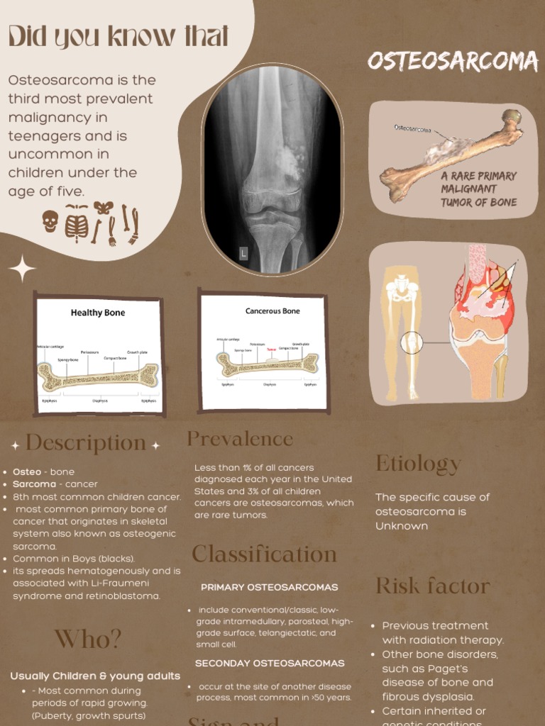 Osteosarcoma PDF | PDF | Cancer | Sarcoma