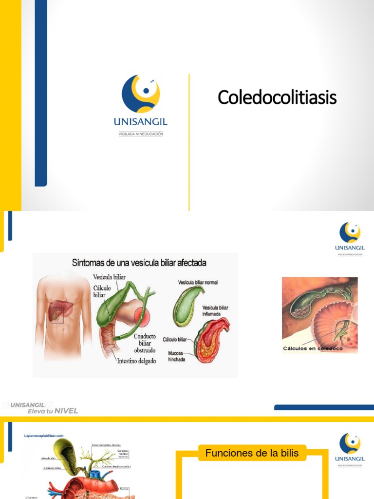 Coledocolitiasis PDF | PDF