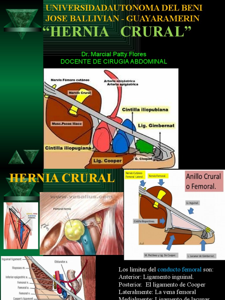 Hernia Crural | PDF | Abdomen | Especialidades Medicas
