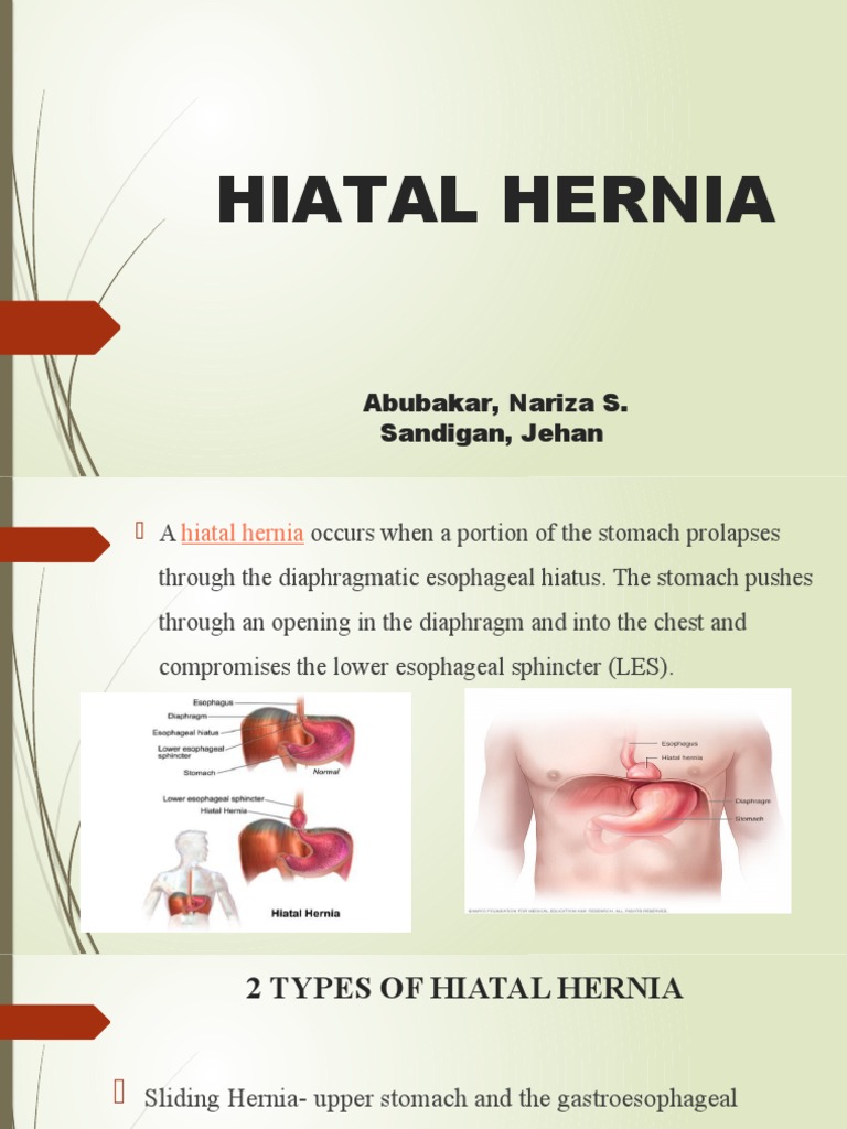 Hiatal Hernia | PDF | Esophagus | Digestive Diseases