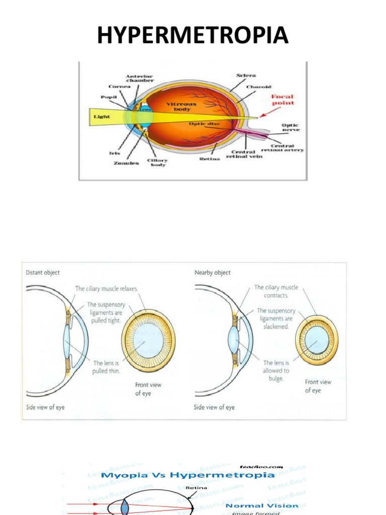 HYPERMETROPIA and Myopia PDF | PDF | Human Eye | Diseases And Disorders