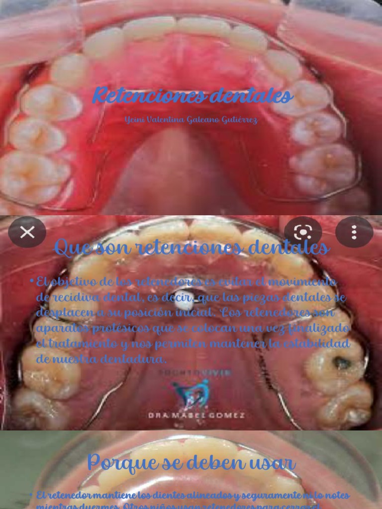 Retenciones Dentales | PDF | Dentadura postiza | Ortodoncia