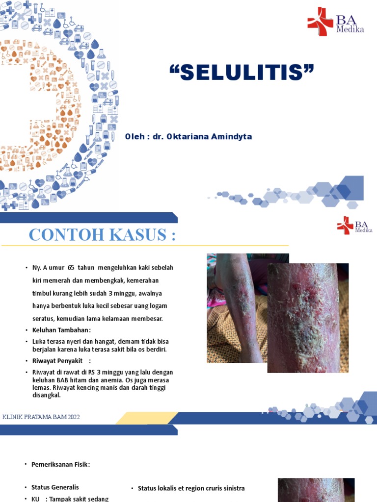 CELULITIS | PDF