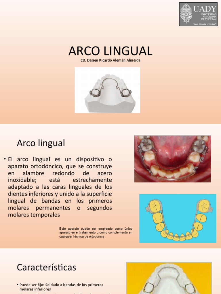 Arco Lingual: Funciones y Usos en Ortodoncia | PDF | Ortodoncia