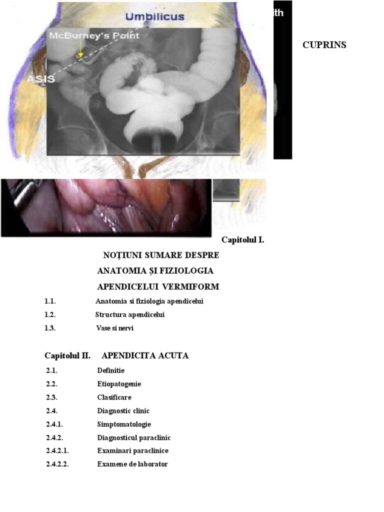 Apendicita Acuta | PDF