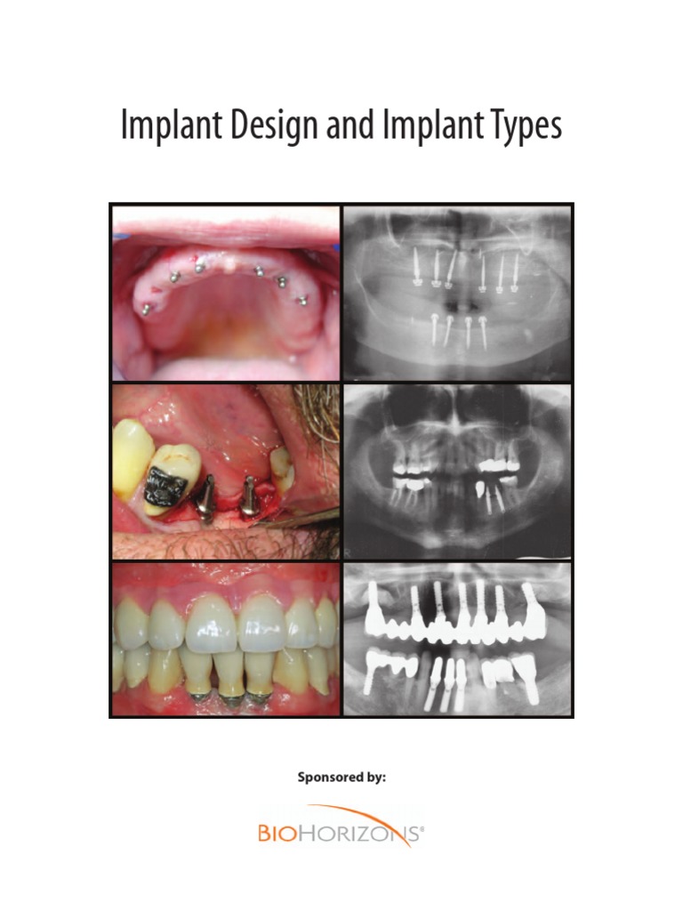 Mini Dental Implants | PDF | Dental Implant | Dentures