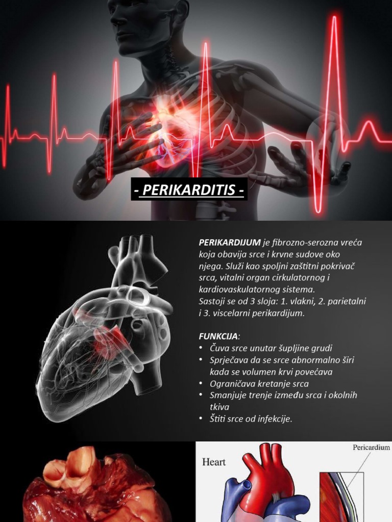 Perikarditis | PDF
