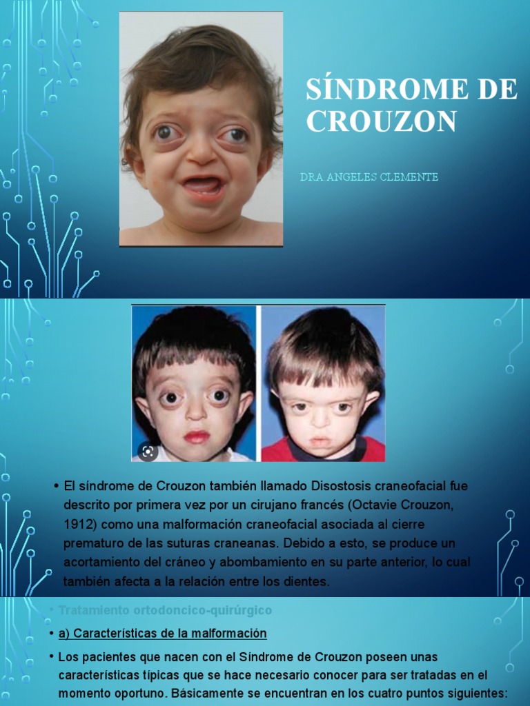 Sindrome de Crouzon 2 | PDF