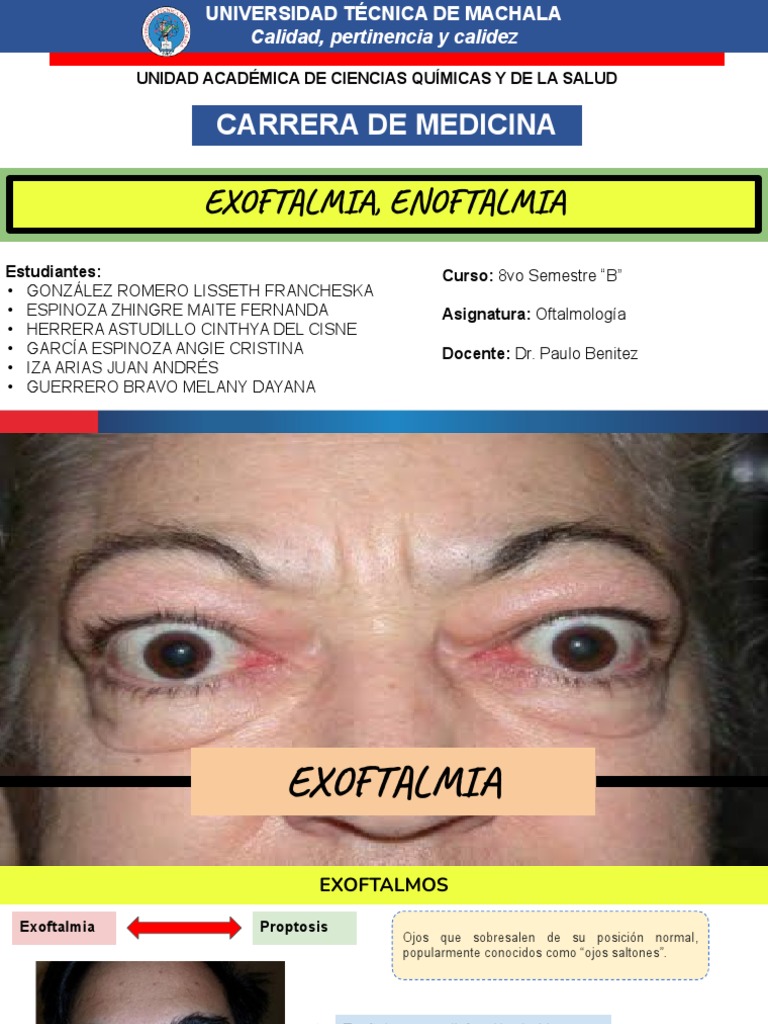 Exoftalmia y Proptosis en Oftalmología | PDF | Especialidades Medicas ...