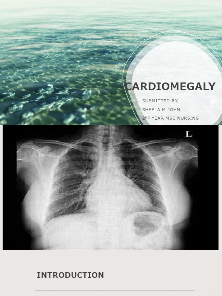 An Overview of Cardiomegaly: Causes, Symptoms, Diagnosis and Treatment ...