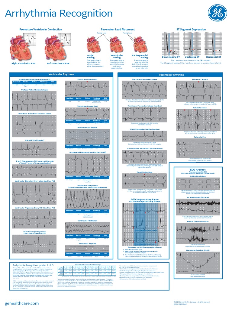 Arrhythmia Recognition Poster Part 2 | PDF | Artificial Cardiac Pacemaker | Electrocardiography