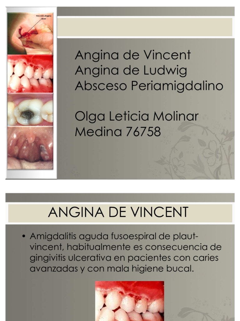 Angina de Vicent | PDF | Salud y bienestar