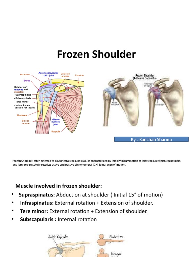 Frozen Shoulder: By: Kanchan Sharma | PDF | Anatomical Terms Of Motion ...