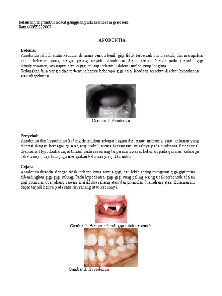 Kelainan Gigi Akibat Gangguan Kromosom Gonosom: Anodontia | PDF
