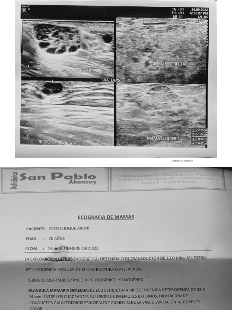 Ecografía de Mamas | PDF