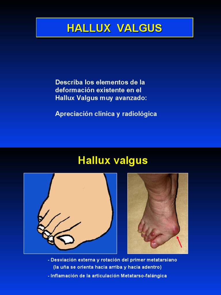 Hallux Valgus: Clasificación y Tratamiento | PDF | Sistema esquelético ...