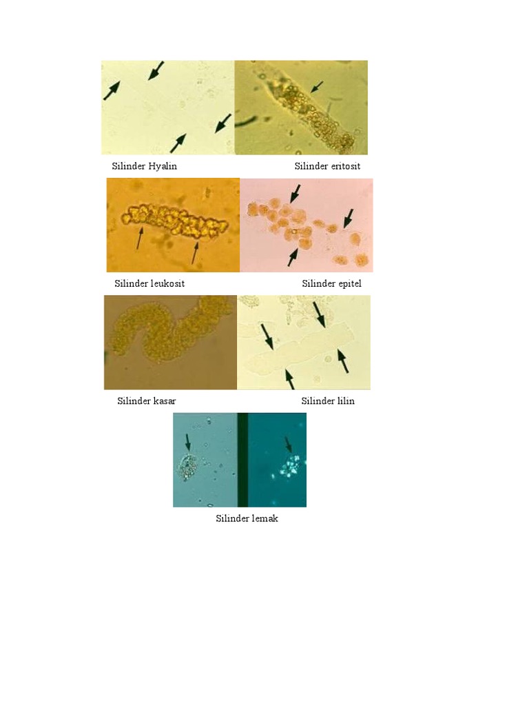 Jenis Silinder Urine dan Gambarnya | PDF