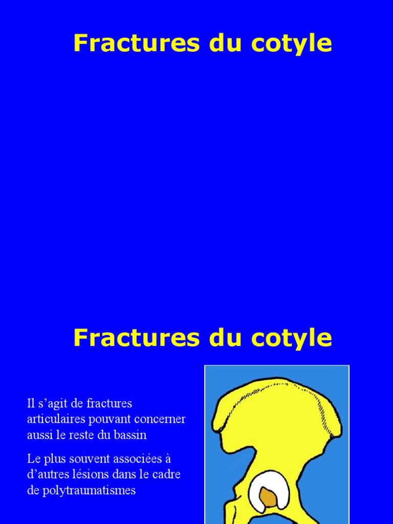Fractures de Cotyle 2023 | PDF | Bassin (anatomie) | Anatomie humaine