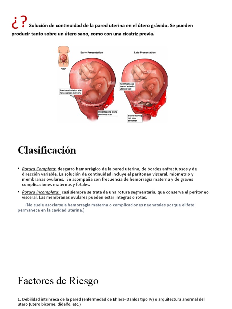 Rotura Uterina | PDF | Parto | Medicina