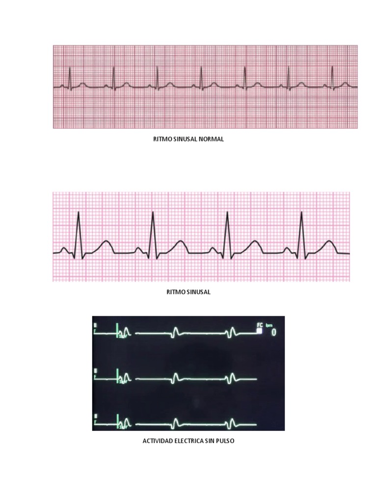 Tipos de Ritmos Cardíacos y RCP | PDF