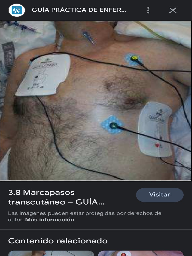 3.8 Marcapasos Transcutáneo - GUÍA Práctica de Enfermería EN EL ... Contenido Relacionado | PDF