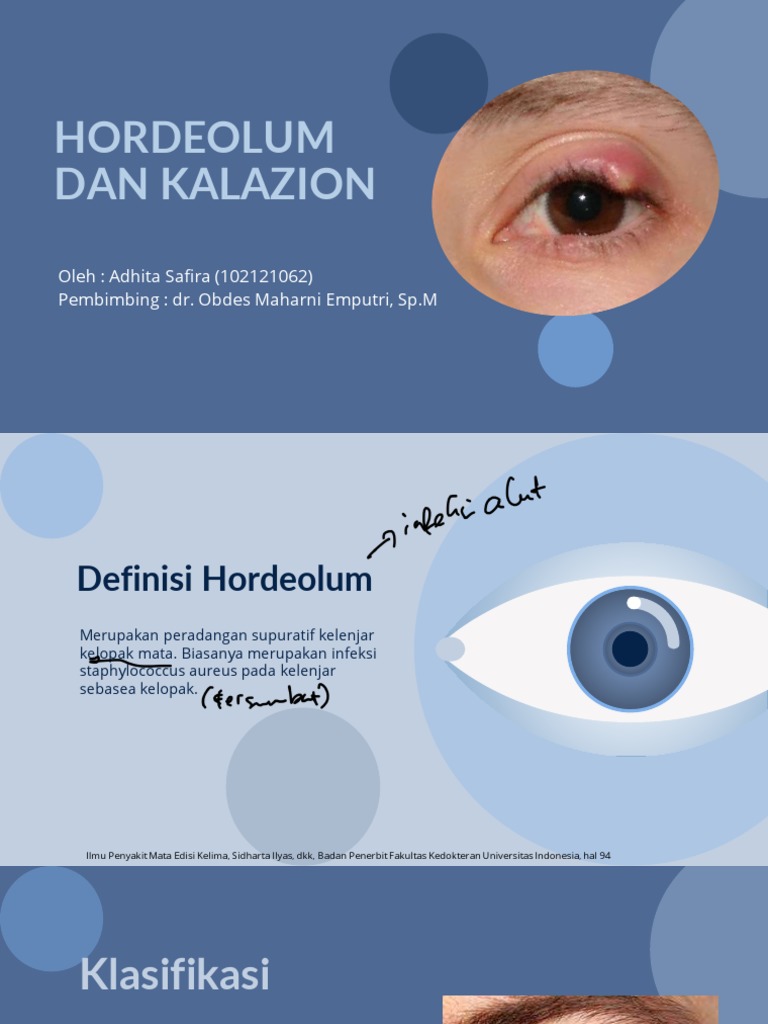 Hordeolum Chalazion - ADHITA | PDF