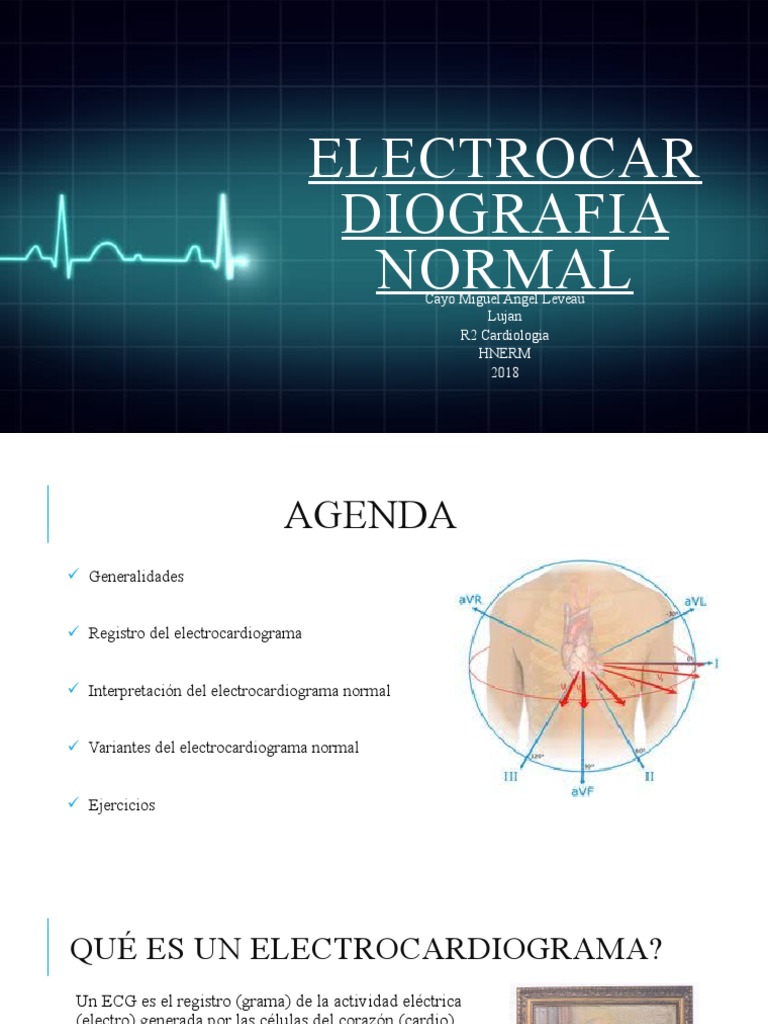 Electrocar Diografia Normal: Cayo Miguel Angel Leveau Lujan R2 Cardiologia Hnerm 2018 | PDF ...
