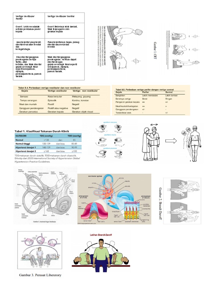 Vertigo Vestibuler Perifer | PDF