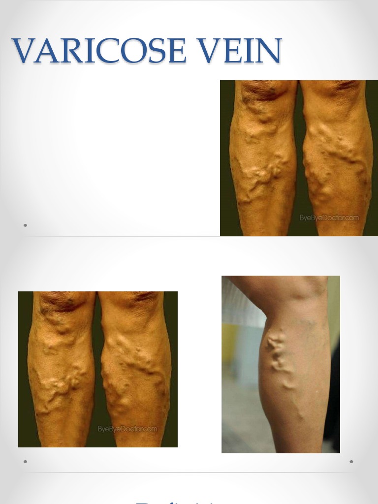 Varicose Vein | PDF | Vein | Medical Specialties