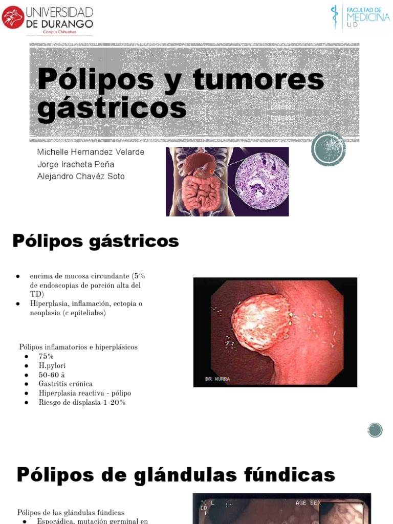 Pólipos De Estómago: Que Son, Síntomas Y Tratamiento – OWFCT