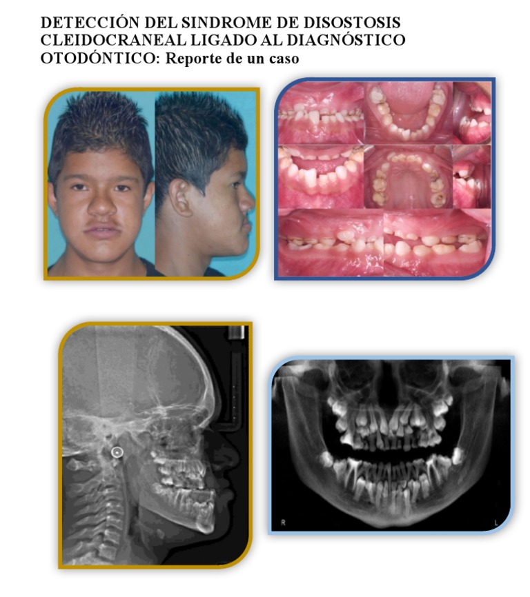 Detección Del Sindrome de Disostosis Cleidocraneal Ligado Al | PDF