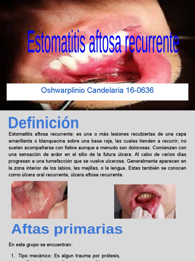 Estomatitis Aftosas Recurrente | PDF | Medicina CLINICA ...