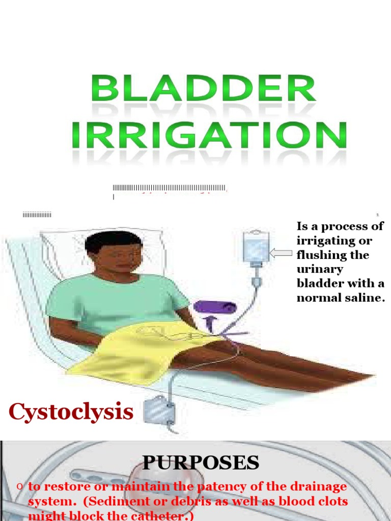 Continuous Bladder Irrigation Tubing