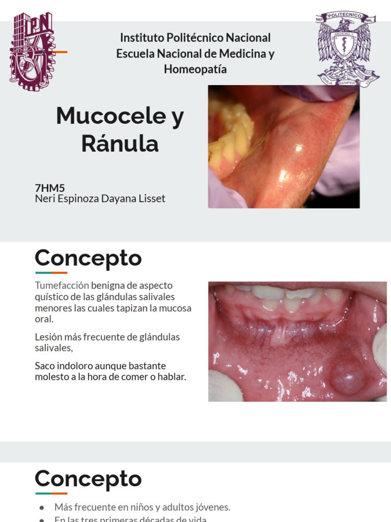 Mucocele y Ránula | PDF | Anatomía | Enfermedades y trastornos