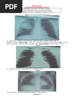 Sémiologie radiologique du syndrome bronchique | PDF | Poumon ...