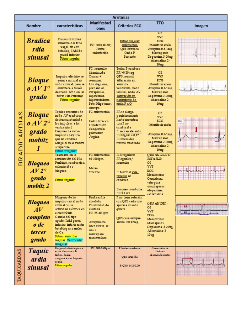 Arritmias-tabla | PDF | Electrocardiografia | Causas de la muerte