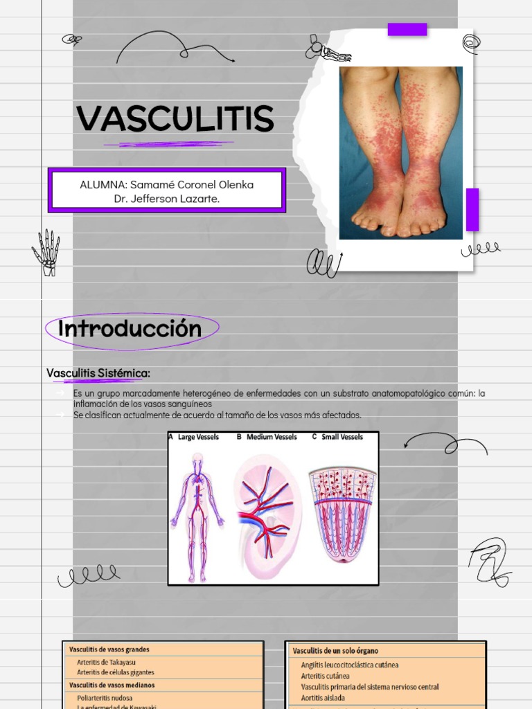 VASCULITIS | PDF | Isquemia | Epidemiología