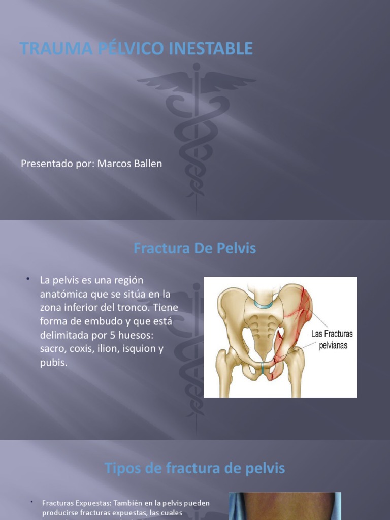 Trauma Pélvico Inestable: Presentado Por: Marcos Ballen | PDF | Pelvis ...