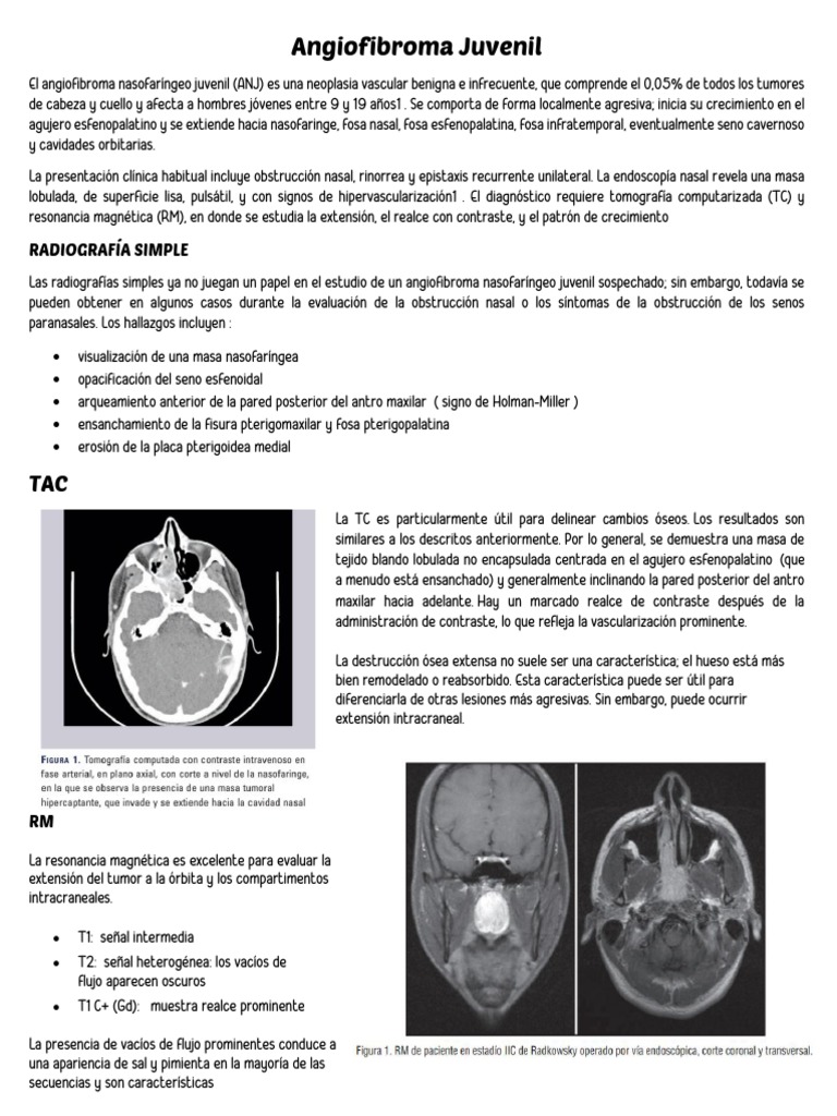 Angiofibroma Juvenil | PDF | Ct Scan | Anatomía humana