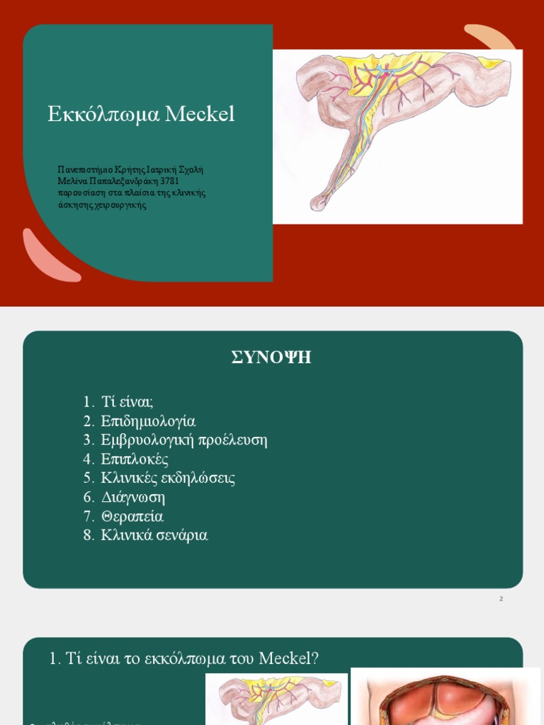 Meckels Diverticulum | PDF