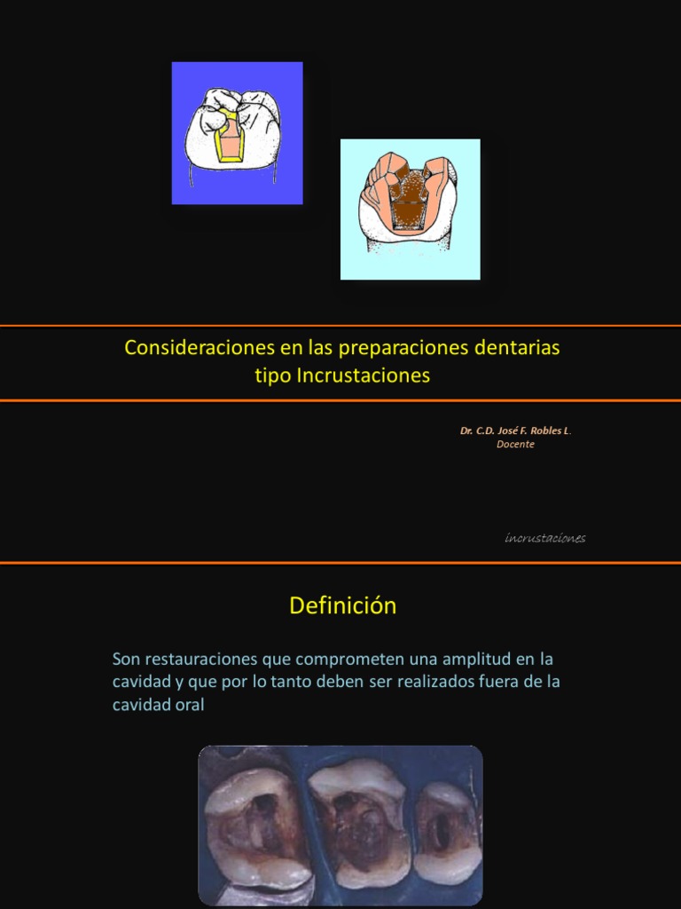 Clase 5 Incrustación Inlays | PDF | Dentadura postiza | Ciencias fisicas