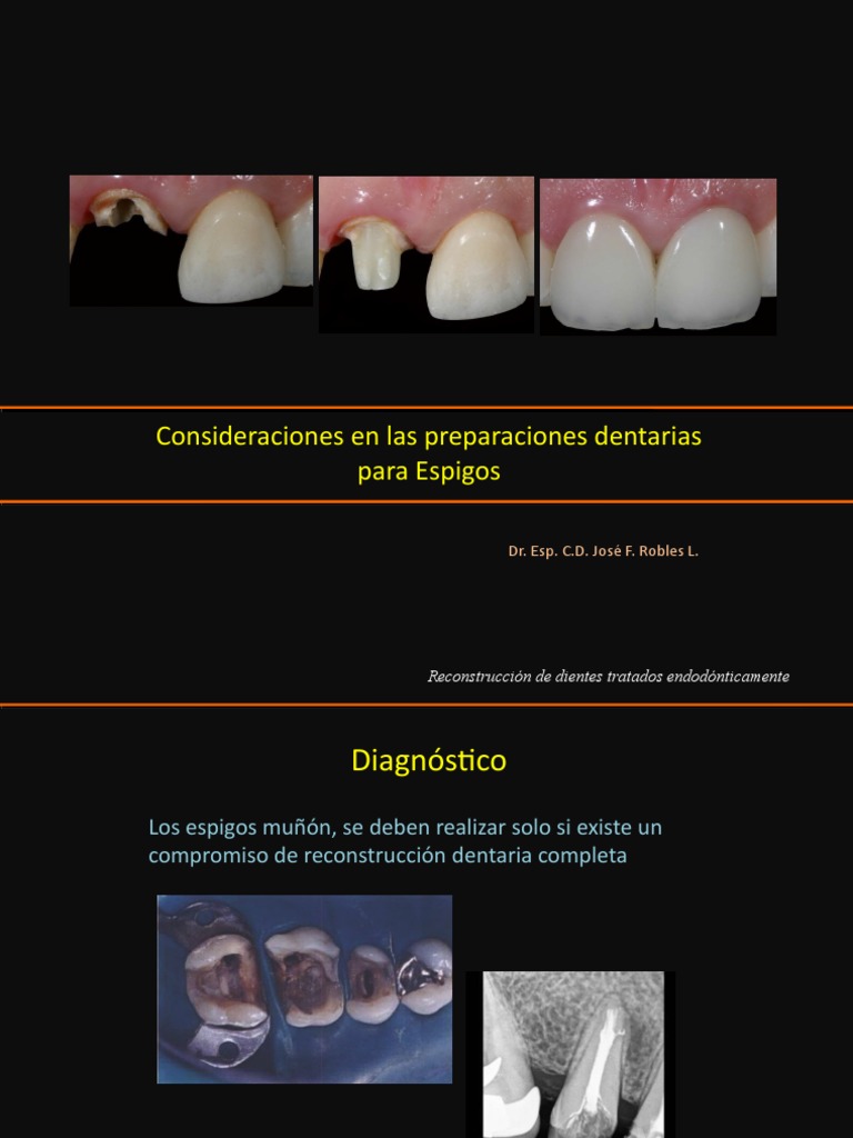 Clase 3 Consideraciones Espigo Anterior | PDF | Dentadura postiza ...