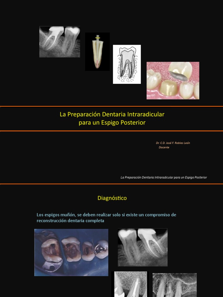 Preparación de Espigo Prefabricado | PDF | Dentadura postiza | Ciencias ...