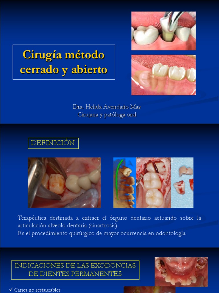 2021 Cirugia Exodoncia Metodo Cerrado y Abierto | PDF | Especialidades Medicas | Medicina CLINICA