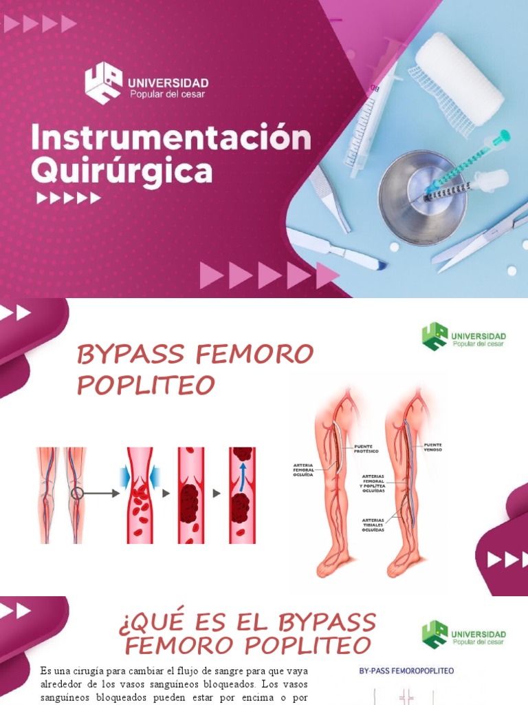 Bypass Femoropoplíteo: Técnica Quirúrgica | PDF | Cirugía de bypass de ...