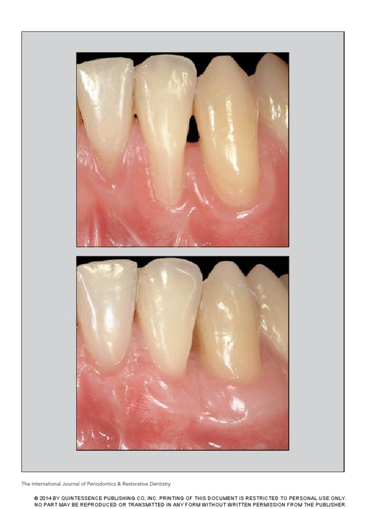 Zucchelli 2014 | PDF | Periodontology | Dentistry Branches