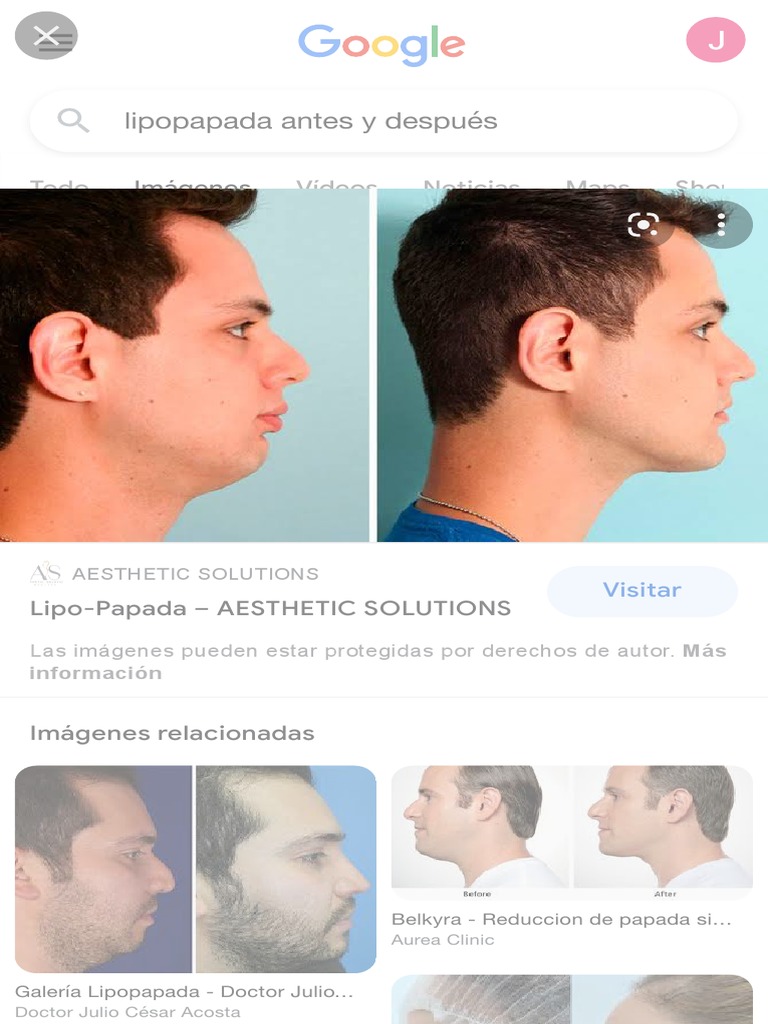 Lipopapada Antes y Después: Todo Vídeos Noticias Maps Shopping | PDF ...