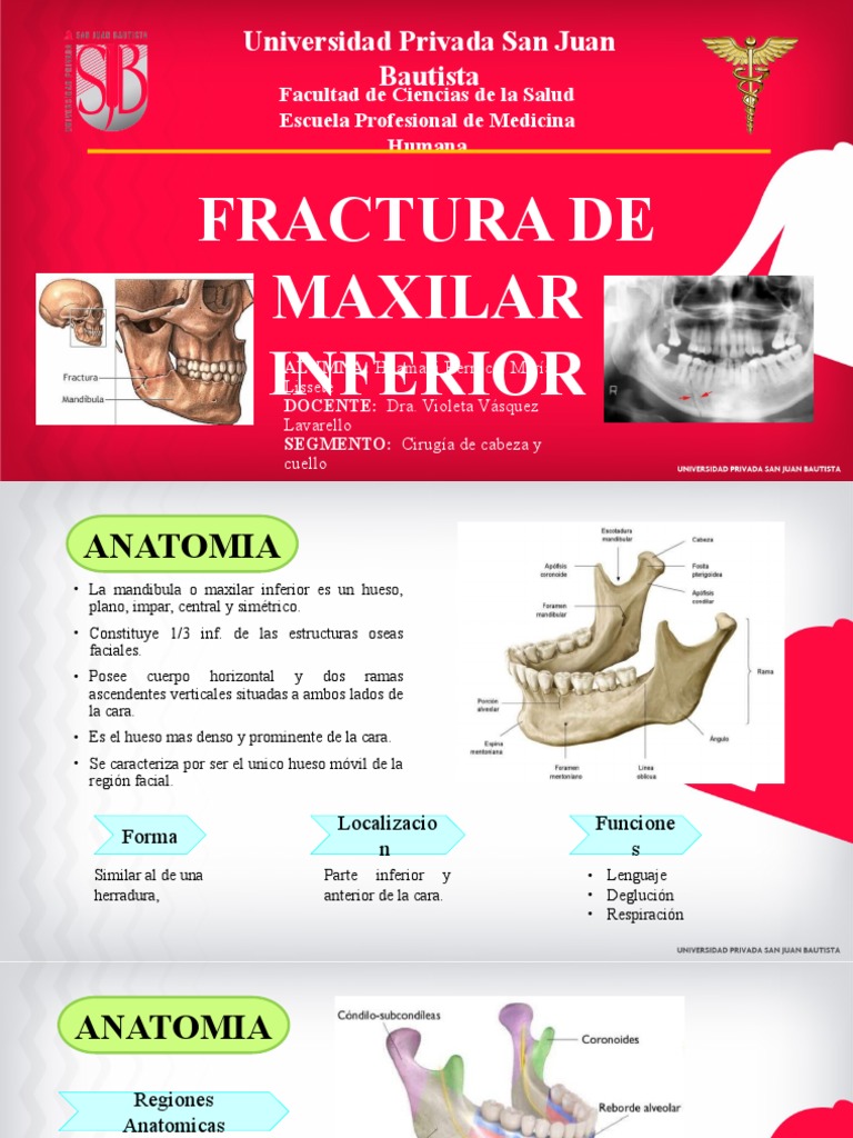 Fractura de Maxilar Inferior: Diagnóstico y Tratamiento | PDF ...