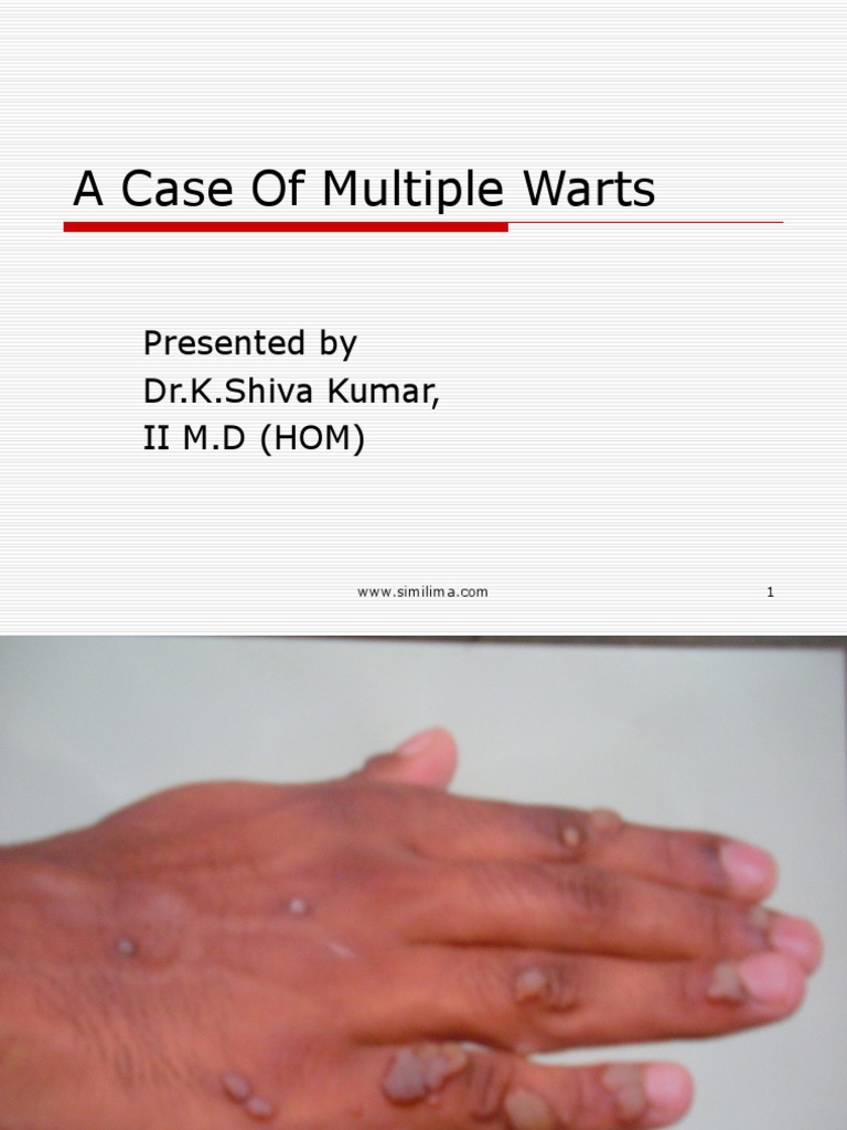 A Case of Multiple Warts: Presented by Dr.K.Shiva Kumar, Ii M.D (Hom) | PDF | Medical ...