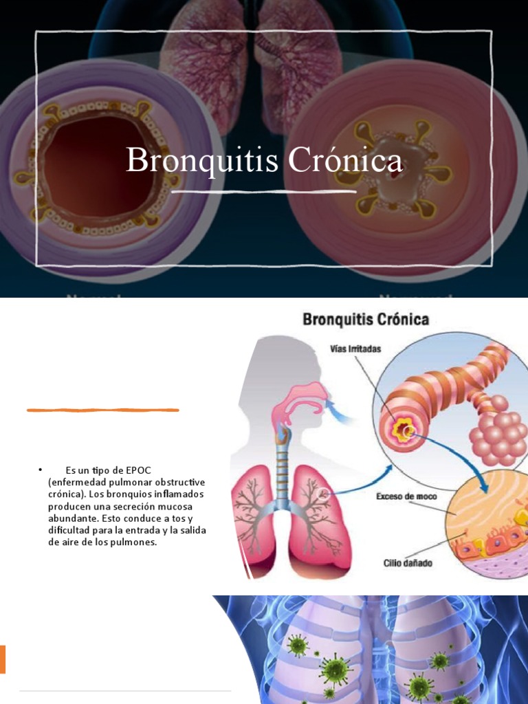 Bronquitis Crónica | PDF | Bronquitis | Tos
